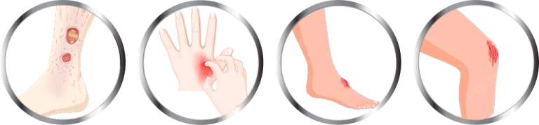 SilvrSTAT – Hydrogel | Tratamiento de Heridas